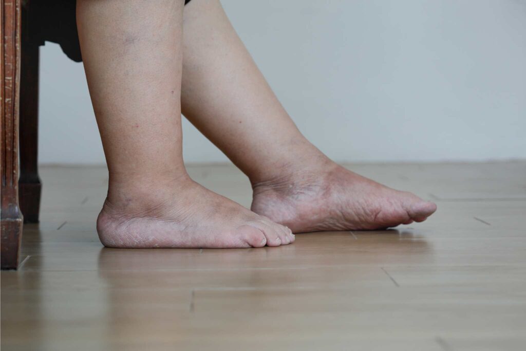 The Dangers of Diabetic Feet - Kalamazoo Podiatry
